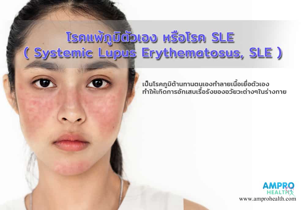 โรคแพ้ภูมิตัวเอง หรือโรค SLE ( Systemic Lupus Erythematosus, SLE ) - AM ...