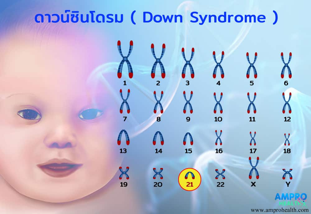 ดาวน์ซินโดรม ( Down Syndrome ) เกิดจากอะไร - AM Pro Health